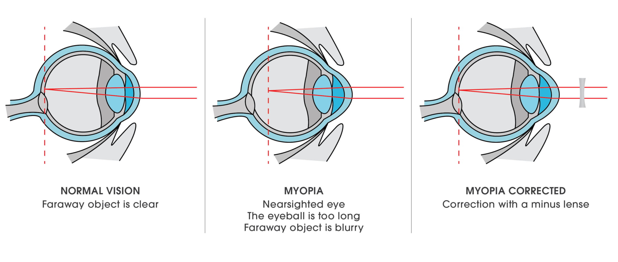 Bolesti oka - Optika Aralica Zagreb & Sisak